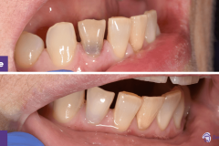 Internal Bleaching in Dental House Group - Melbourne Dental House